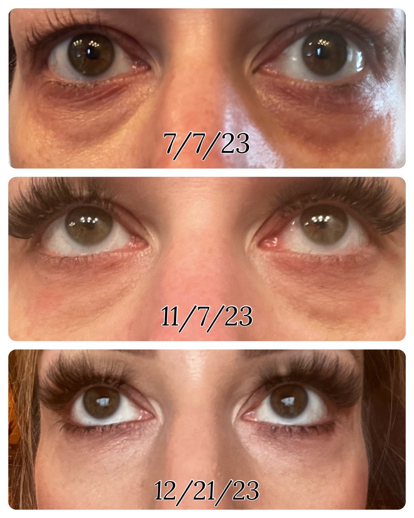 Tear Trough PRP - Precision Aesthetics | Ohio Valley Med Spa